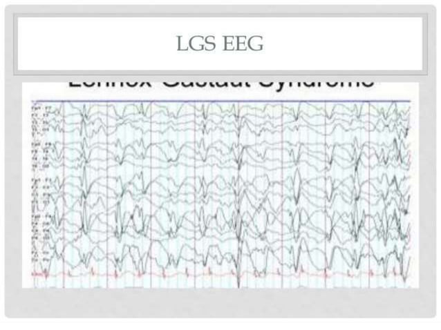 Abnormal EEG patterns | PPTX | Brain and Nervous System Disorders | Diseases and Conditions