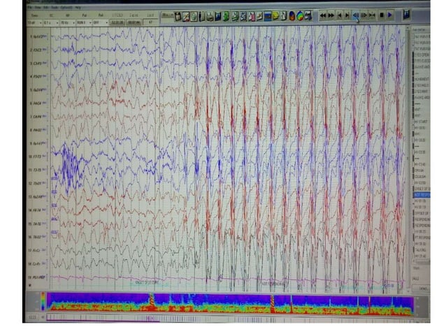 Abnormal EEG patterns