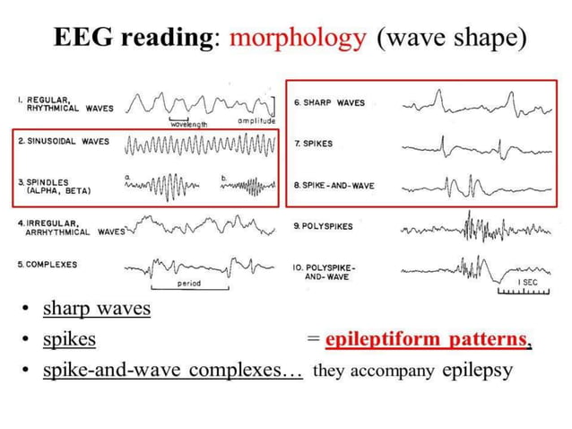 Abnormal EEG patterns | PPT