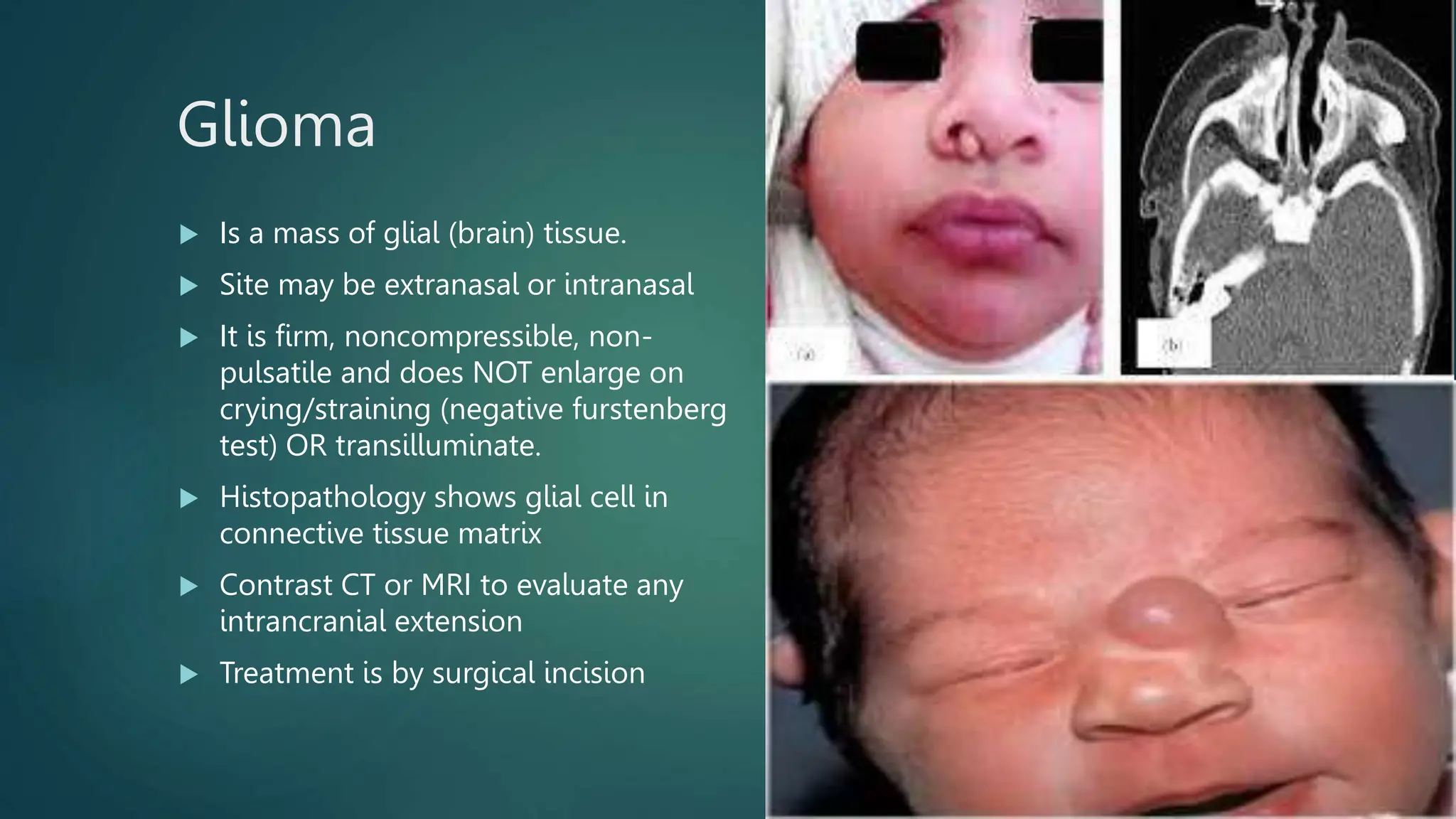 assignx_cong diseaseses_nose&pns_mashrab.pptxassignx_cong diseaseses ...