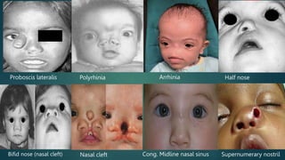 assignx_cong diseaseses_nose&pns_mashrab.pptxassignx_cong diseaseses ...