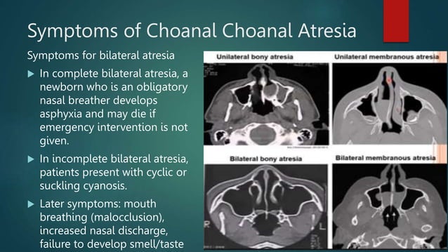 assignx_cong diseaseses_nose&pns_mashrab.pptxassignx_cong diseaseses ...