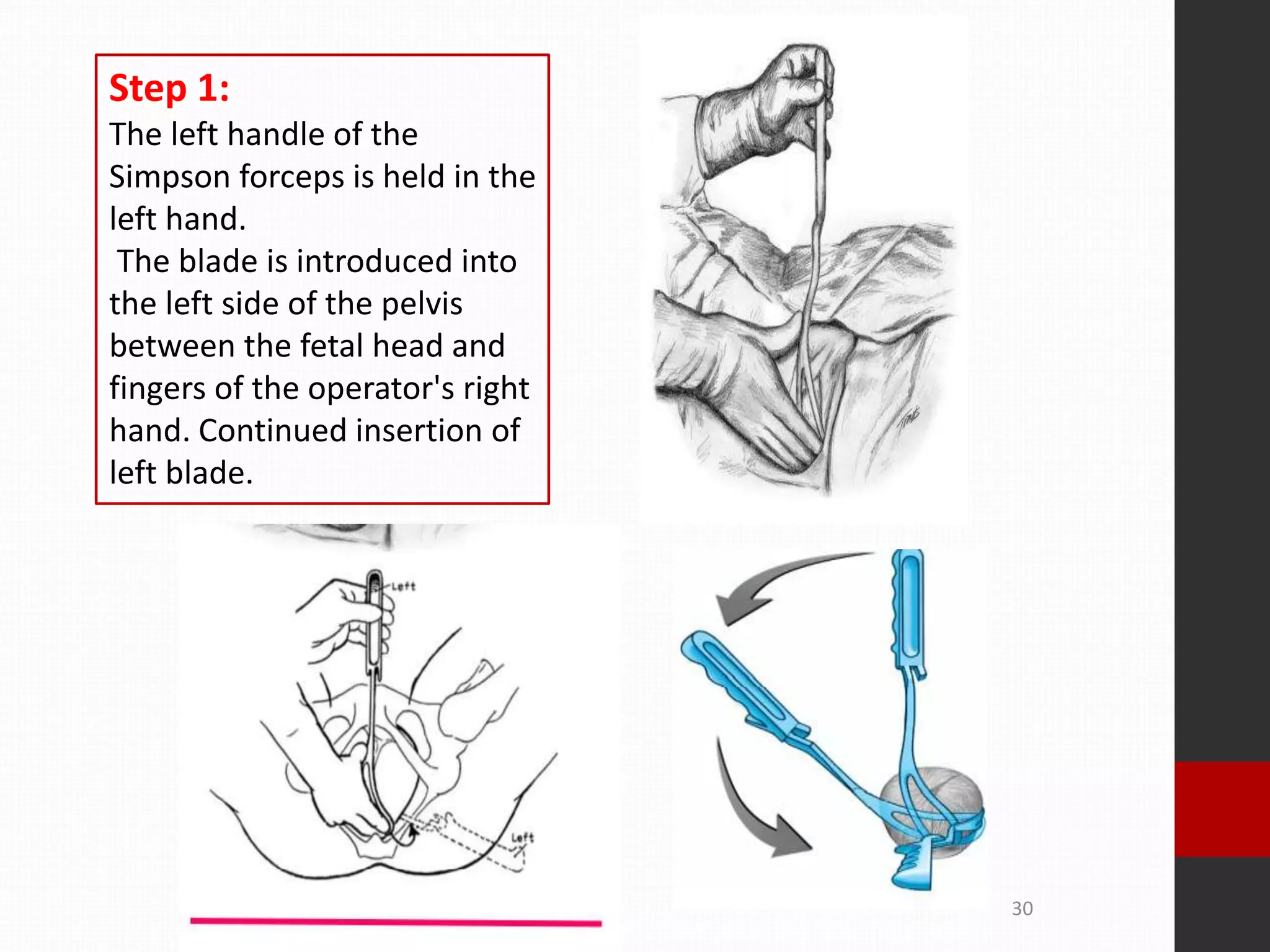 assisted-vaginal-delivary.pptx