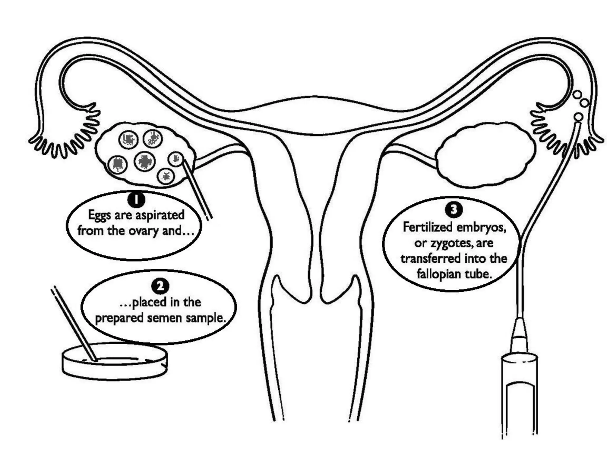 Assisted Reproductive Technique | PDF