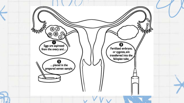 ASSISTED REPRODUCTIVE TECHNIQUES.powerpoint | PPT