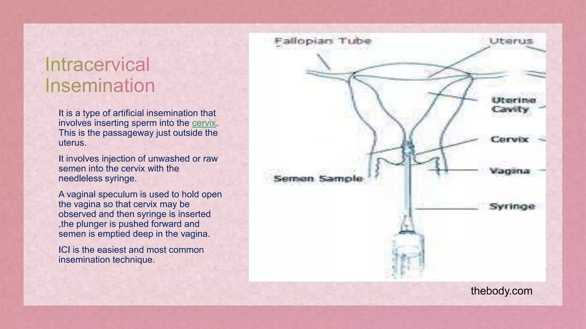 Assisted reproductive techniques | PPT