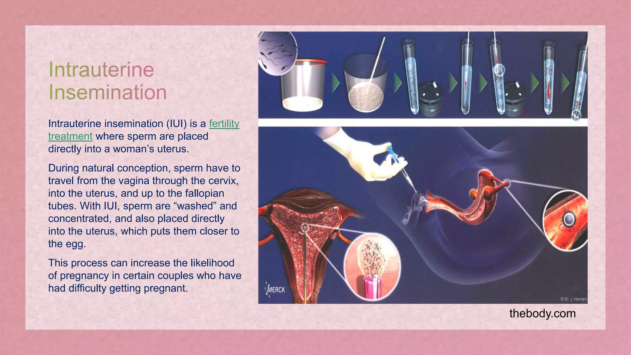 Assisted reproductive techniques | PPT