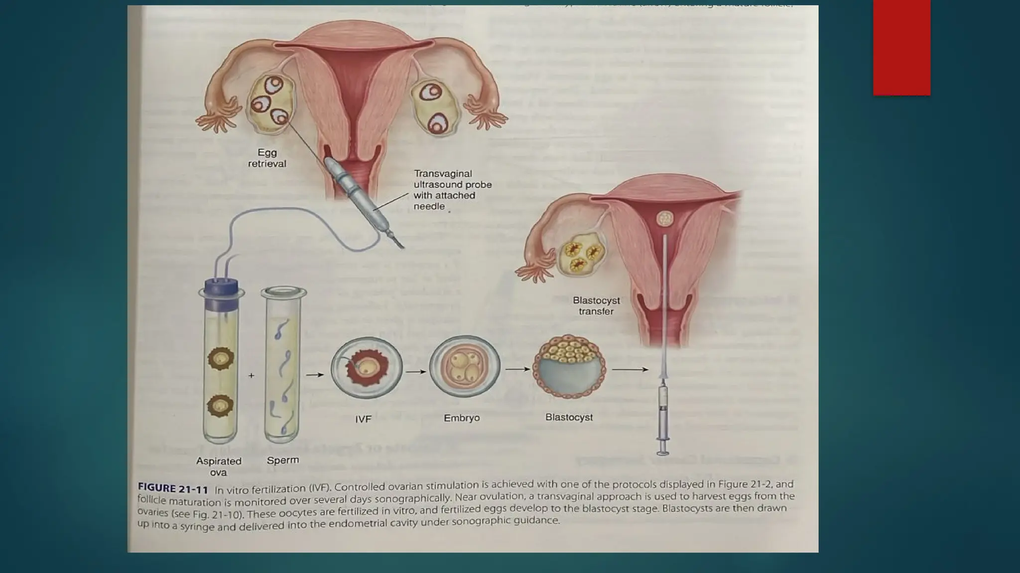 ASSISTED REPRODUCTIVE TECHNIQUES. presen | PPTX