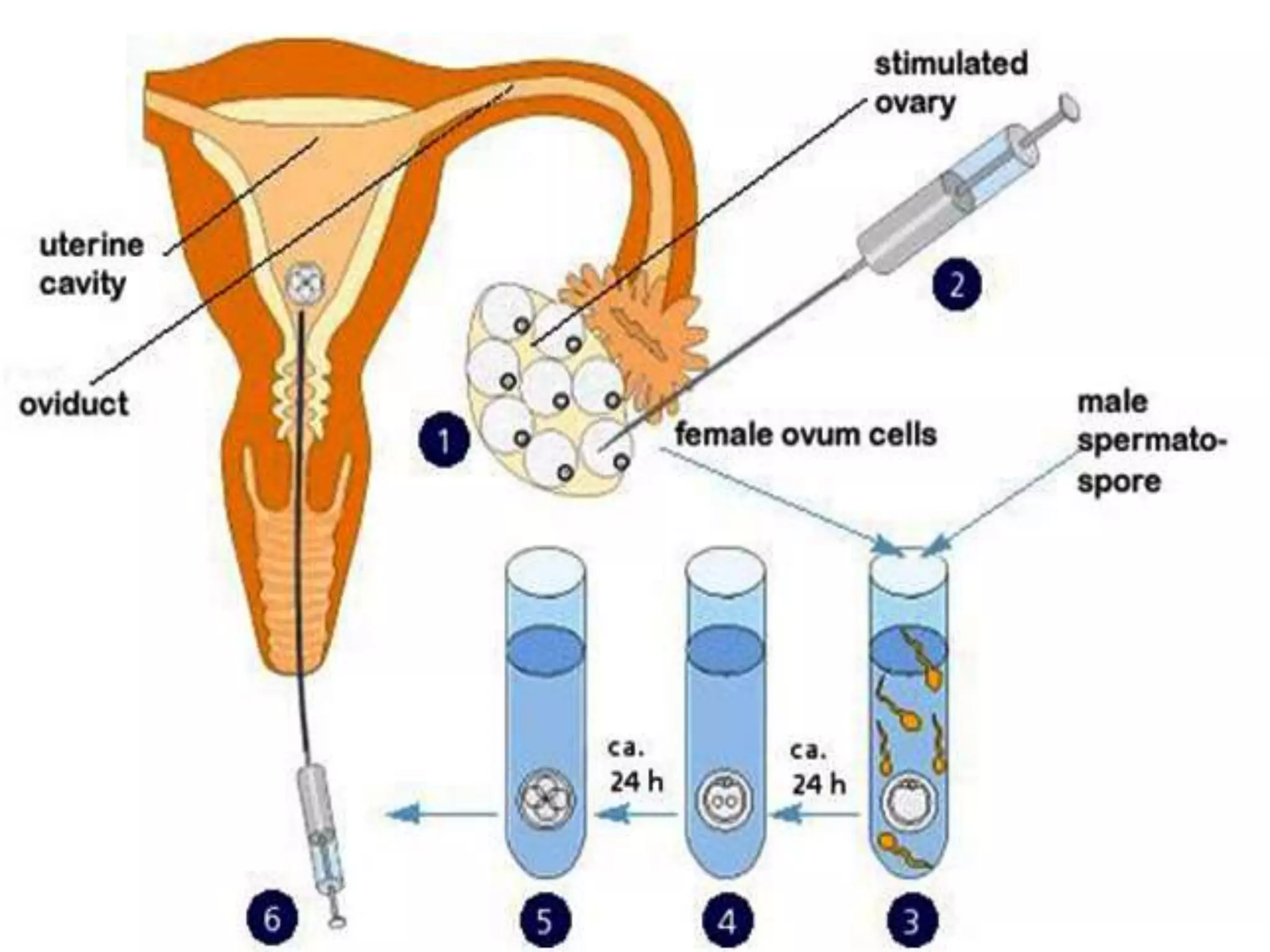 Assisted reproductive techniques | PPTX | Infertility | Reproductive Health