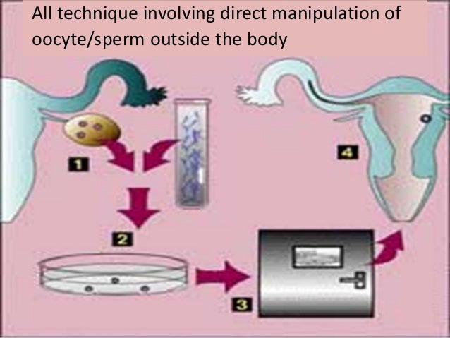 Assisted Reproductive Techniques