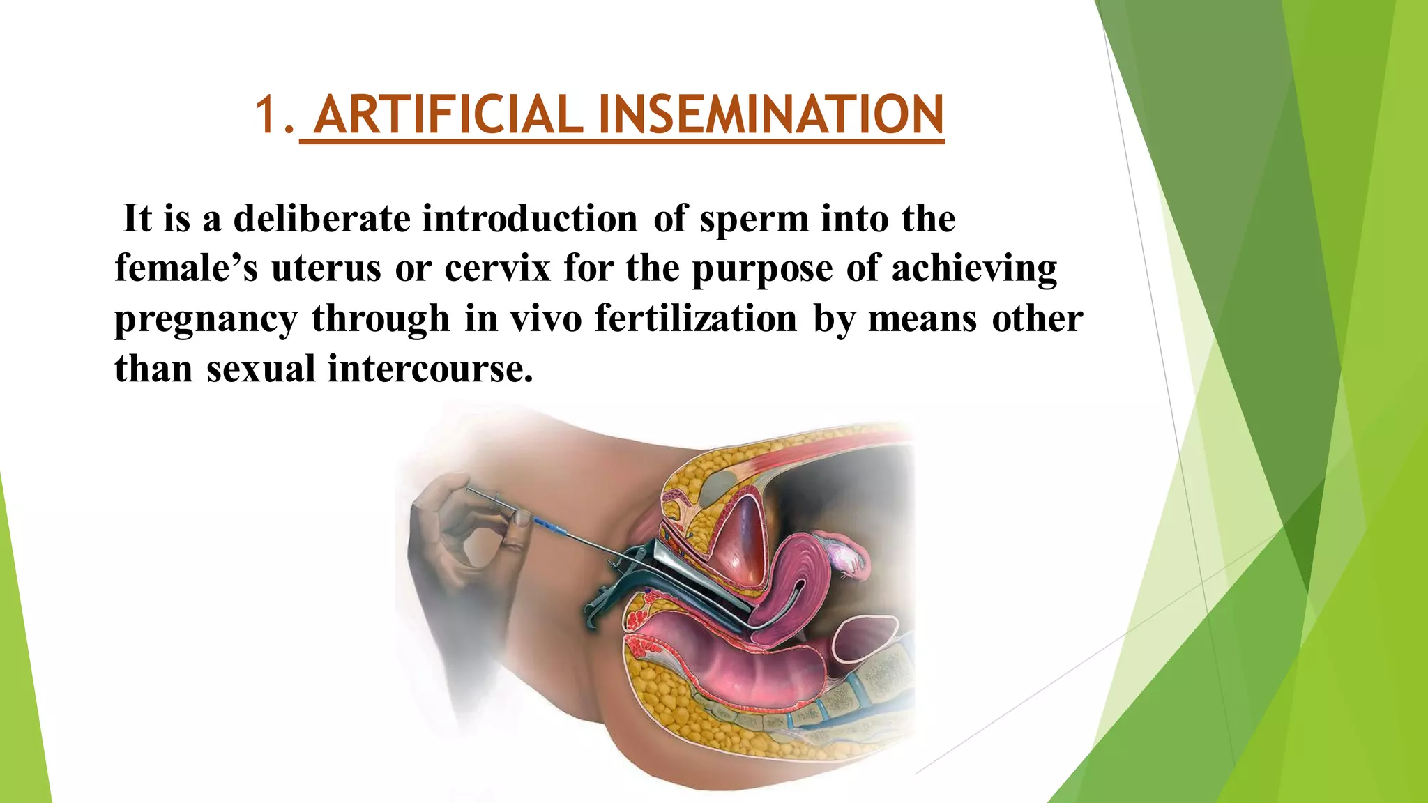 Assisted reproductive technology | PDF