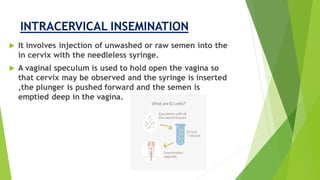 Assisted reproductive technology | PDF