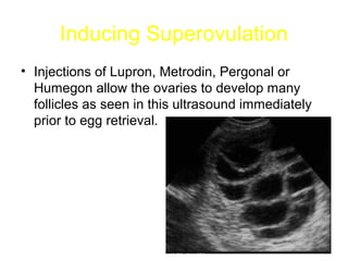 Assisted reproductive technology 1106 ppt | PPT
