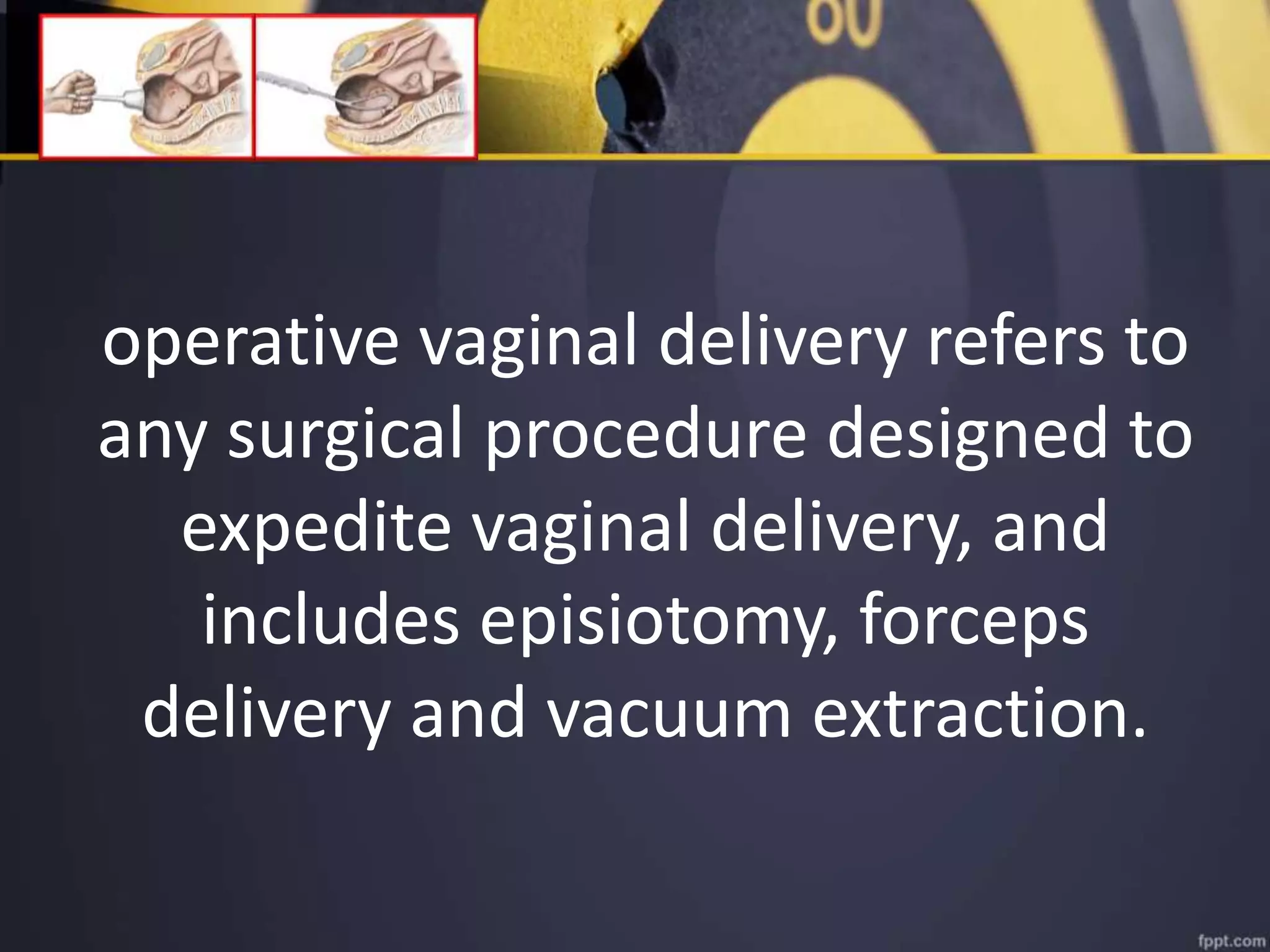 Assisted vaginal delivery | PPTX
