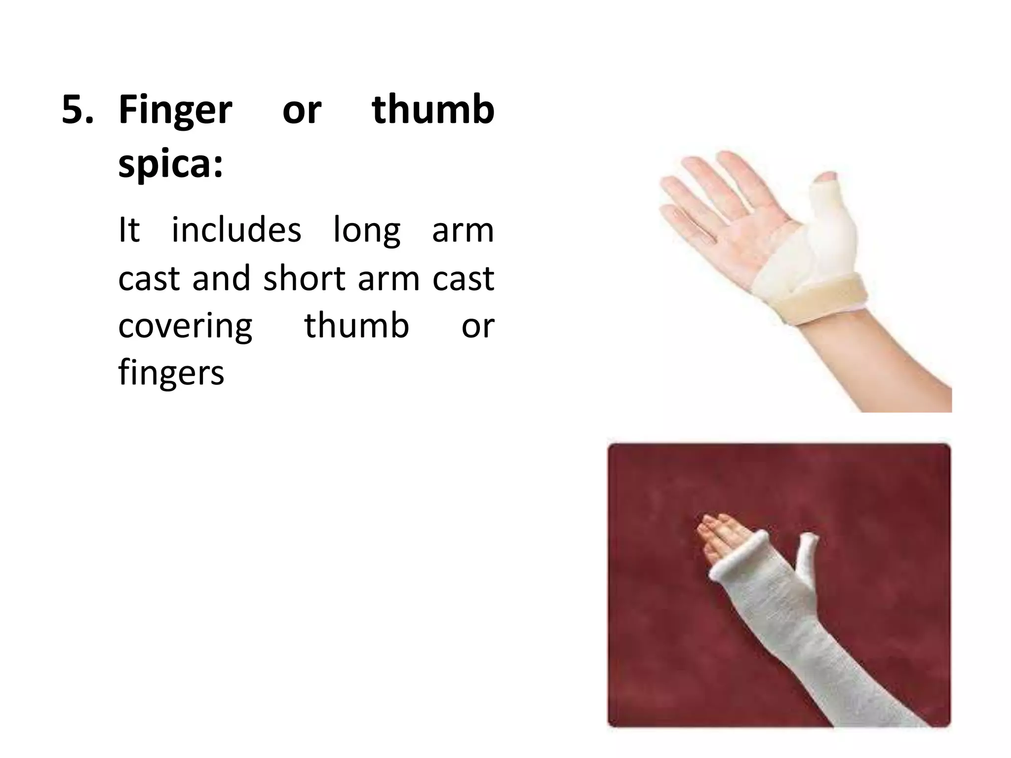 Assist in application & Removal of plaster cast. | PPTX