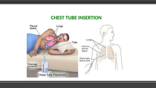 Assisting in Intercostal Chest Drain (ICD) Insertion (2).pptx