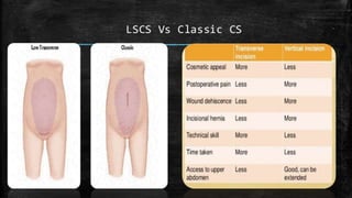 Assisting in lower segment cesarean section | PPTX