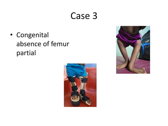 Assistive devices &technology for peadiatric rehabilitation | PPTX