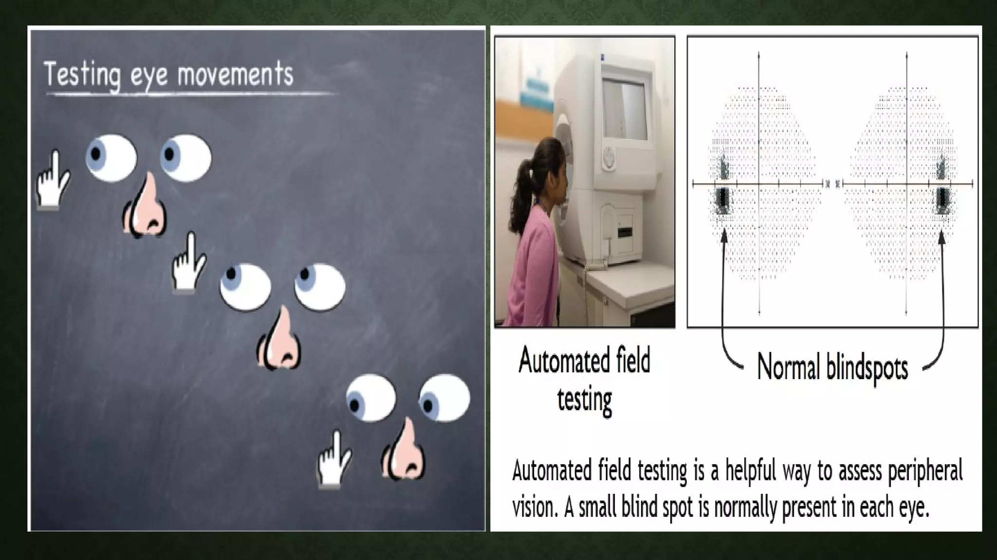 Associated eyes diseases | PPT