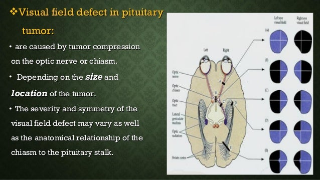 Associated eyes diseases