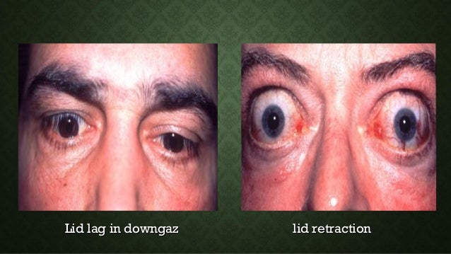 Associated eyes diseases