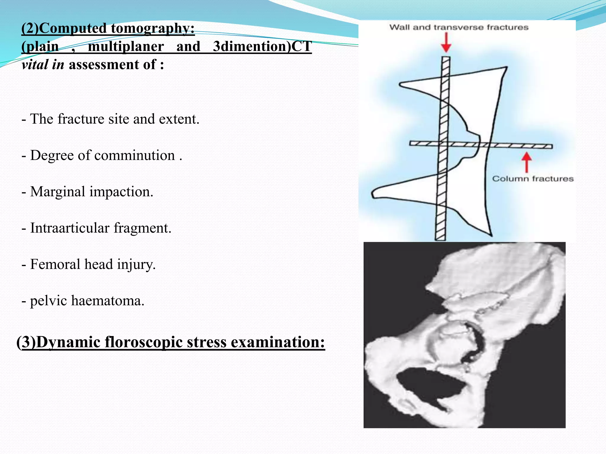 surgical treatment of Associated patterns fracture acetabulum | PPT