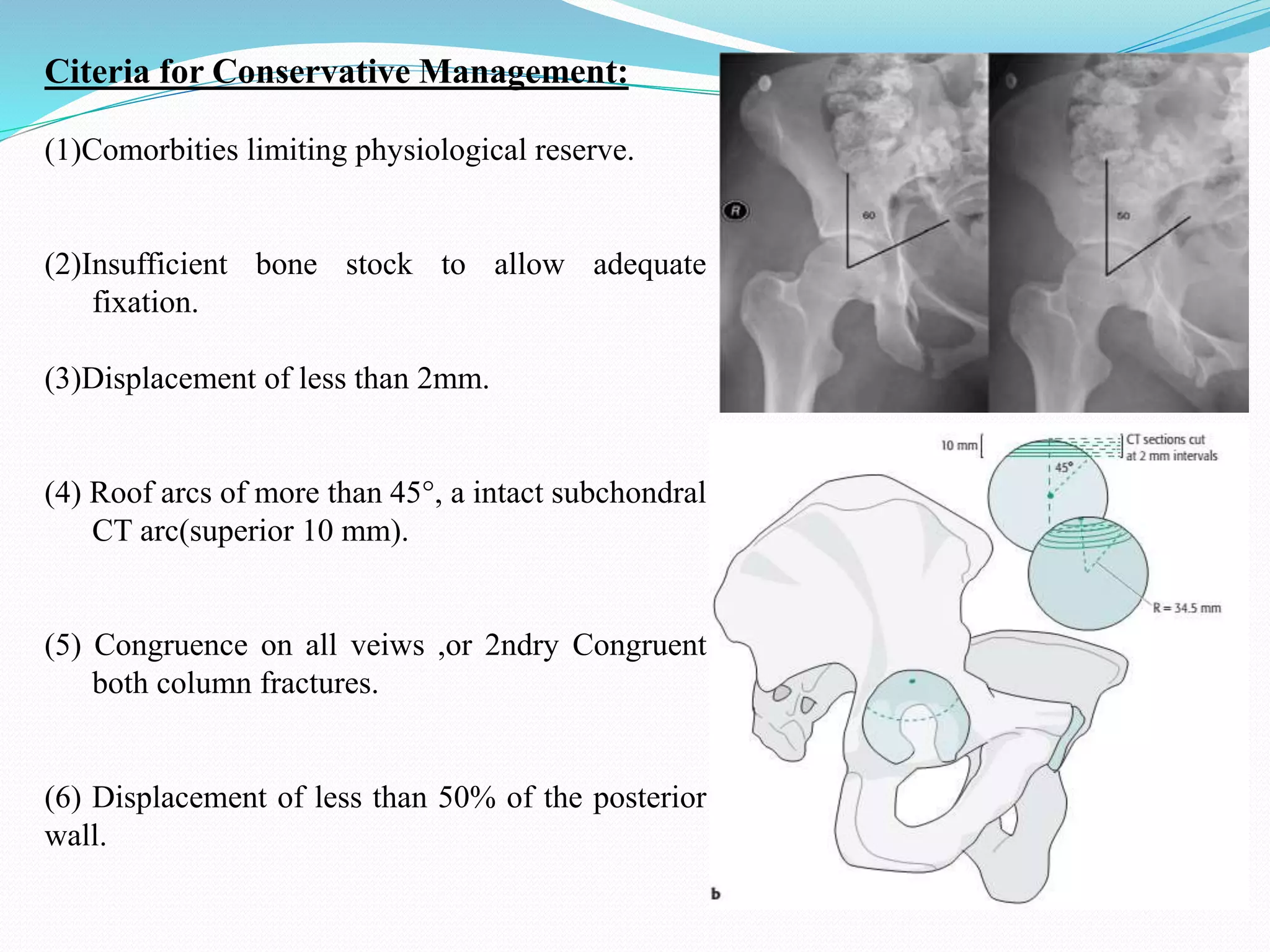surgical treatment of Associated patterns fracture acetabulum | PPT