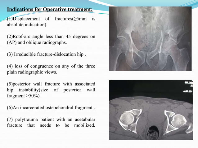 surgical treatment of Associated patterns fracture acetabulum | PPT