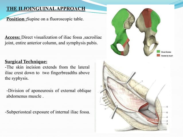 surgical treatment of Associated patterns fracture acetabulum | PPT