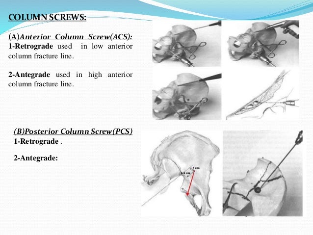 surgical treatment of Associated patterns fracture acetabulum