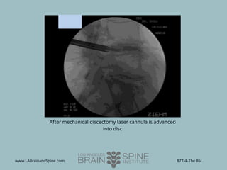 Endoscopic Lumbar Micro-Decompressive Discectomy | PPTX