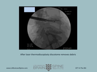 Endoscopic Lumbar Micro-Decompressive Discectomy | PPTX