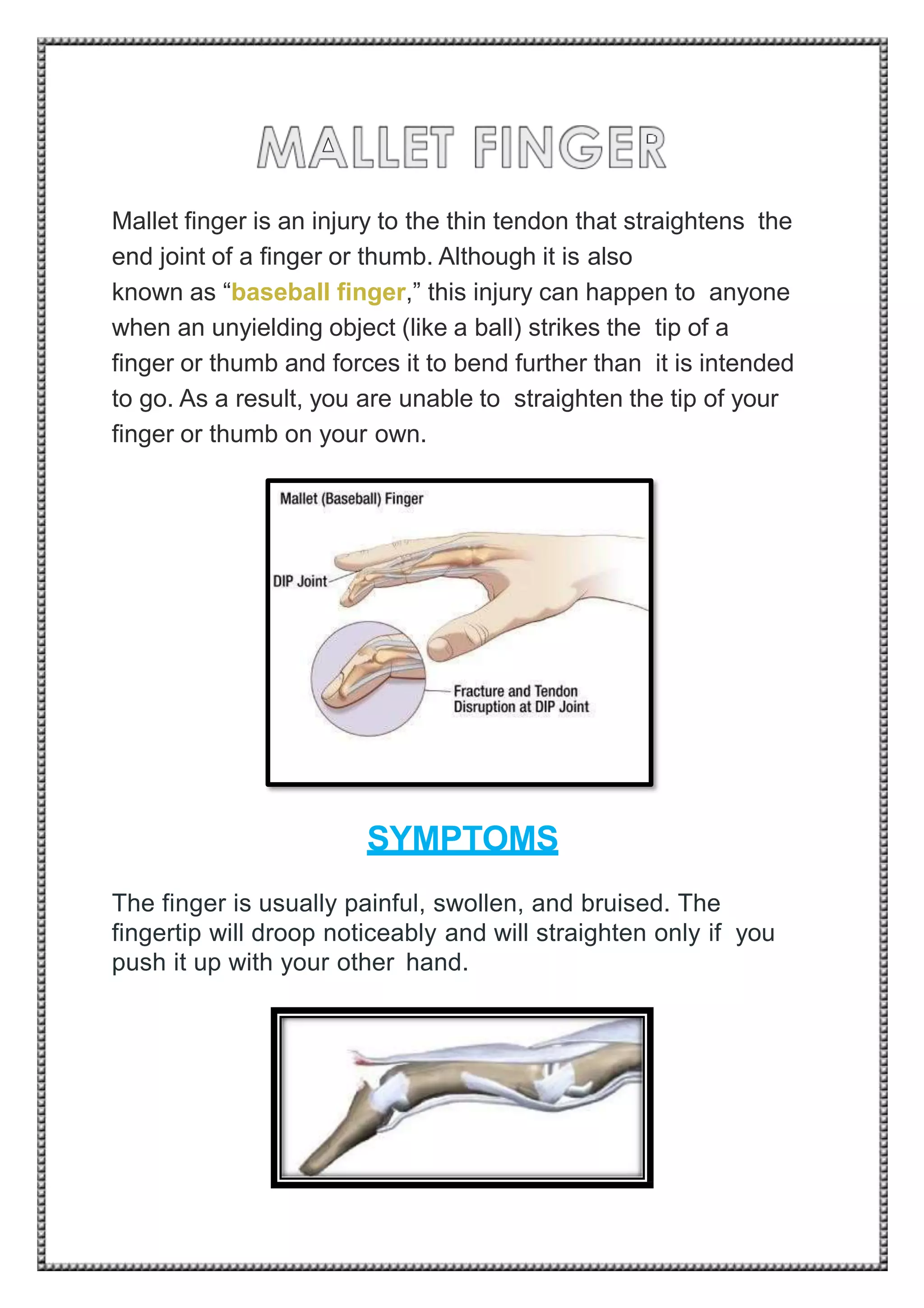 SPORTS INJURIES OF UPPER EXTREMITIES | PPTX