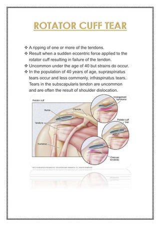 SPORTS INJURIES OF UPPER EXTREMITIES | PPTX
