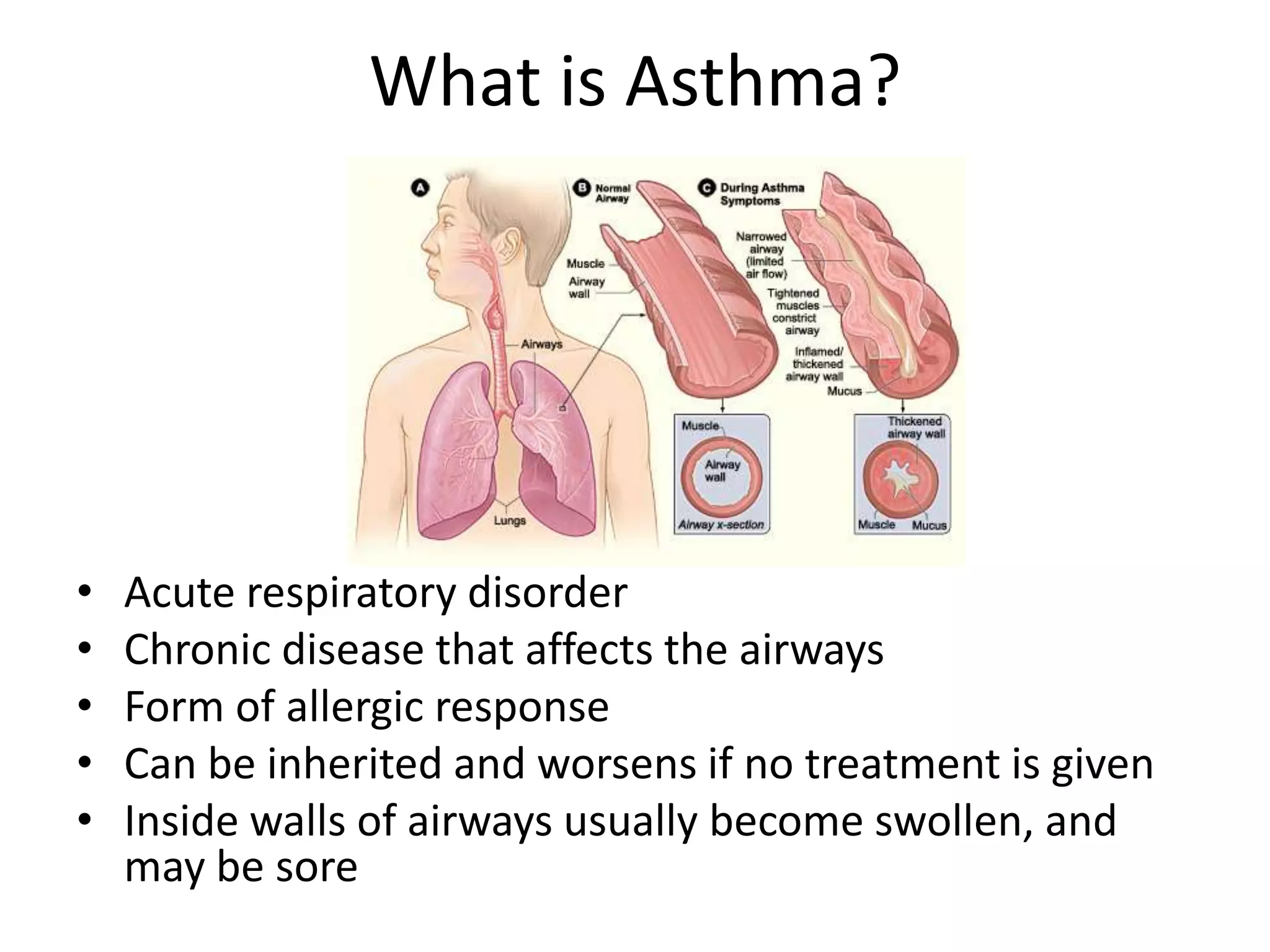 Asthma | PPTX