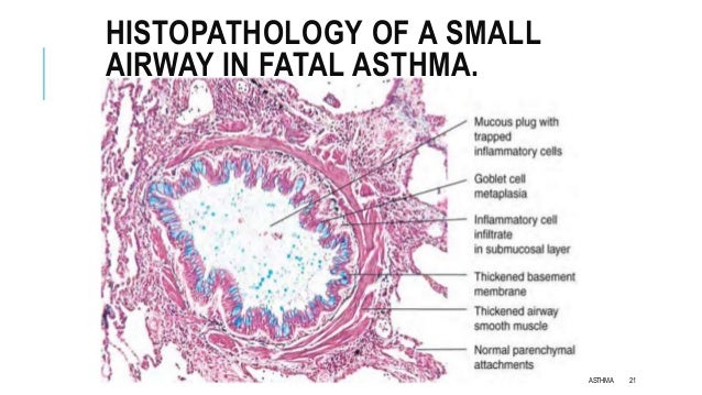 Asthma