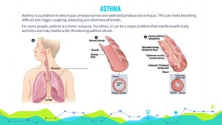 Asthma | Signs, Causes,Triggers and First aid | PPTX