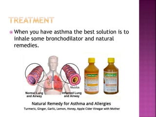 Asthma | PPT