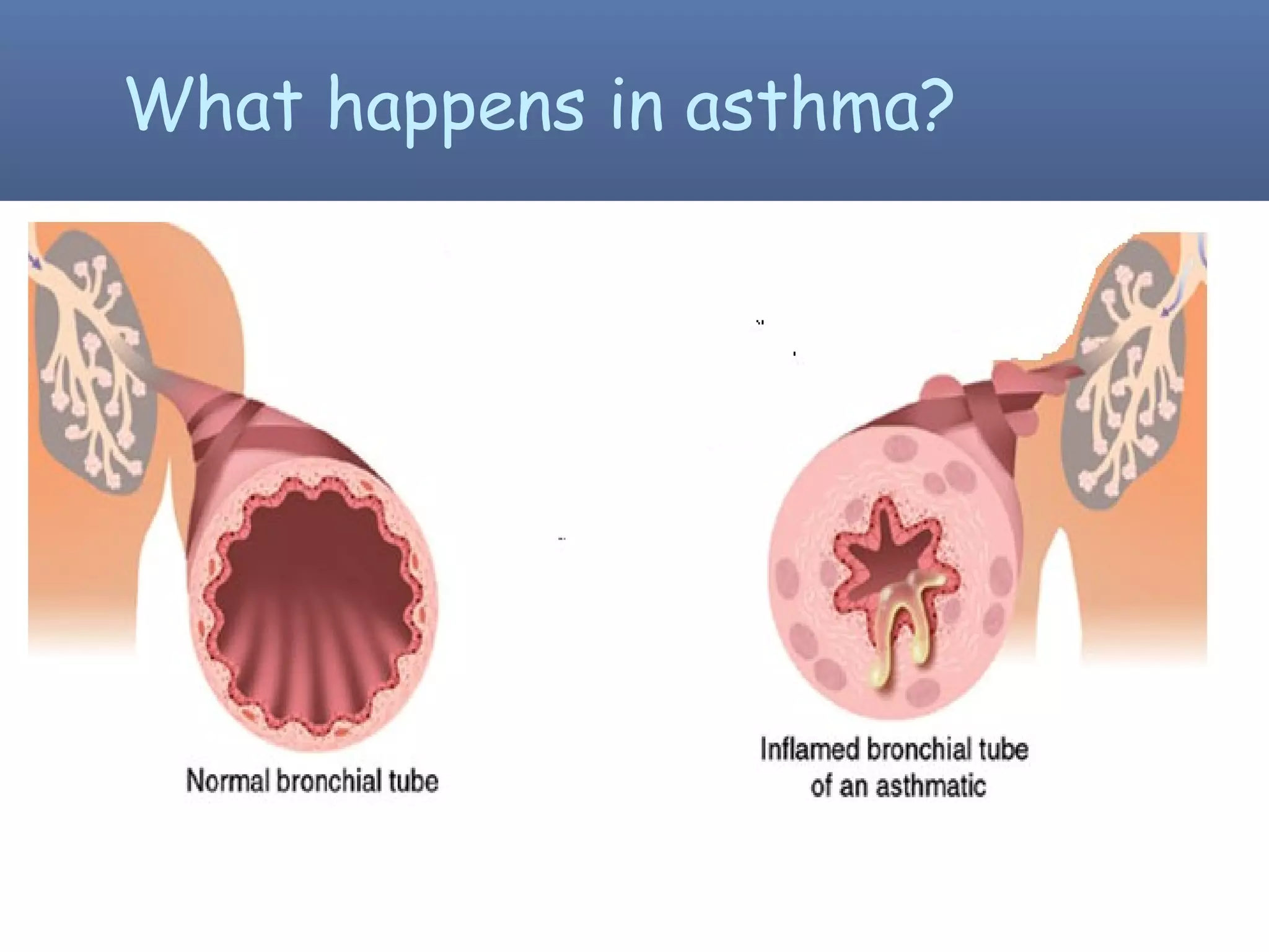 Asthma Ppt
