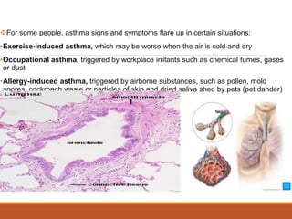 Asthma | PPTX