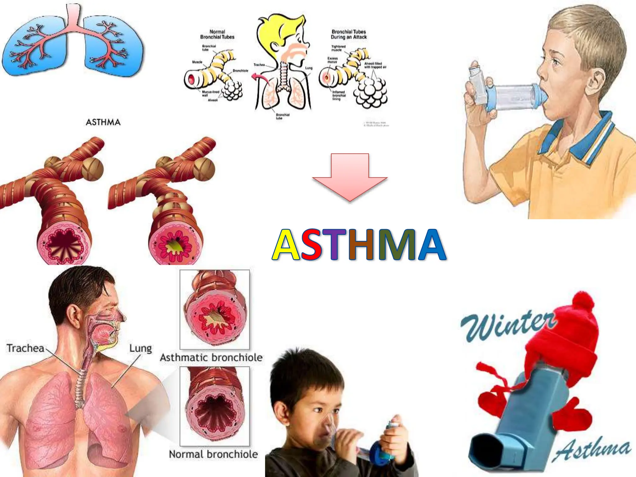 Asthma lecture for medical students .pptx