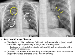 Asthma Lecture For Medical Students 2.pptx