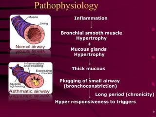 Asthma | PPT