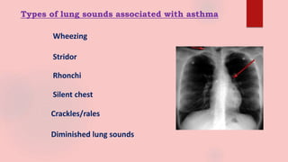 ASTHMA 🫁.pptx
