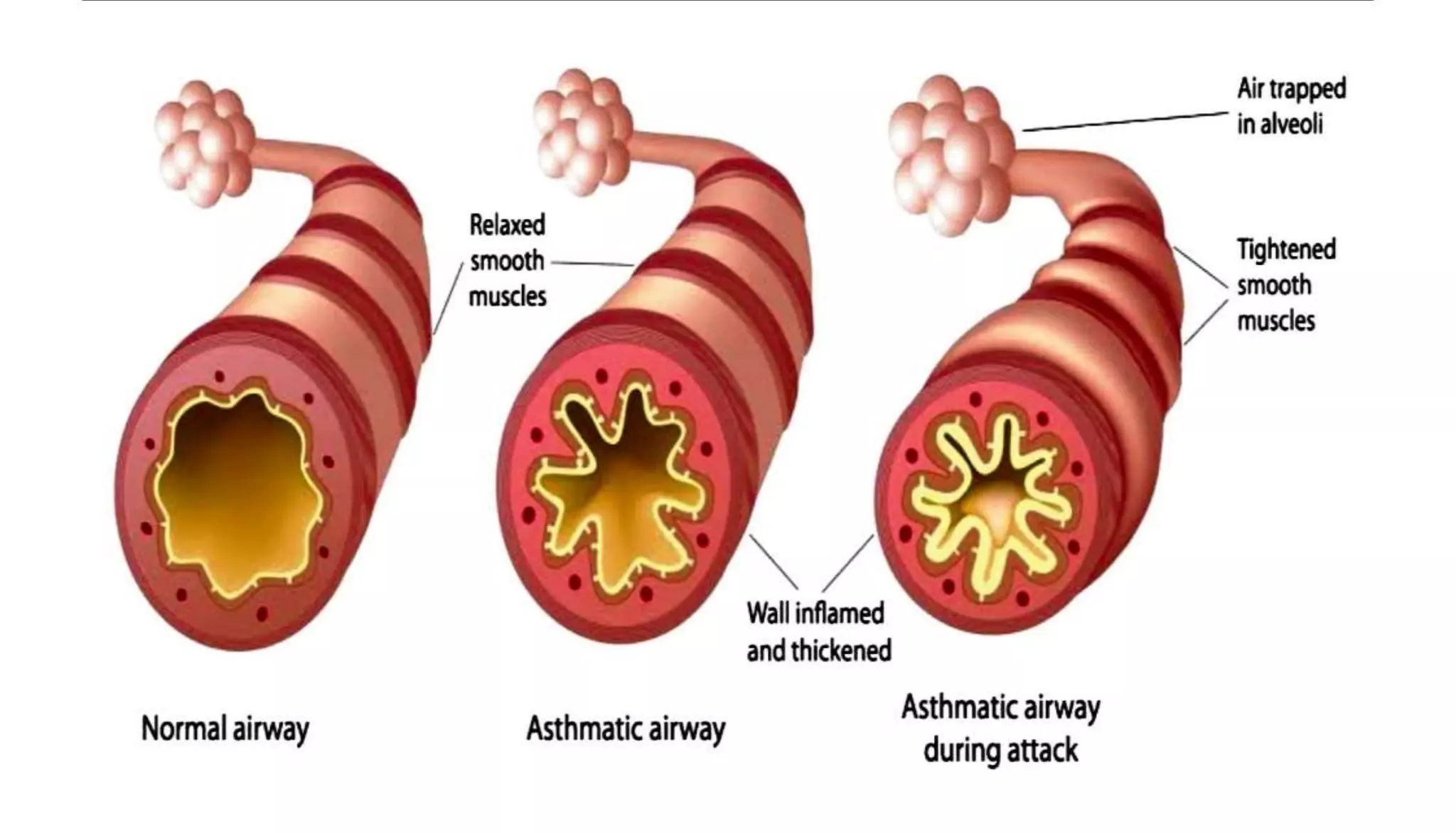 ASTHMA SLIDE SHARE IN RESPIRATORY SYSTEM (MSN) | PPTX