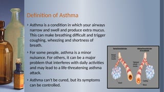 asthma.pptx.pdf | Free Download