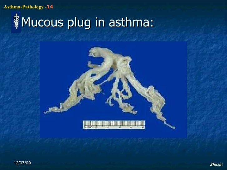 Asthma Pathophysiology N