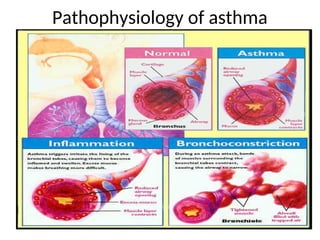 ASTHMA AND HYPERACTIVE AIRWAY DISEASES.ppt