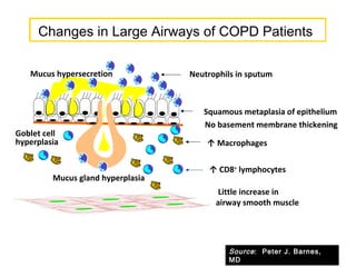 Asthma copd | PPT
