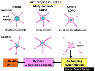 Asthma copd | PPT